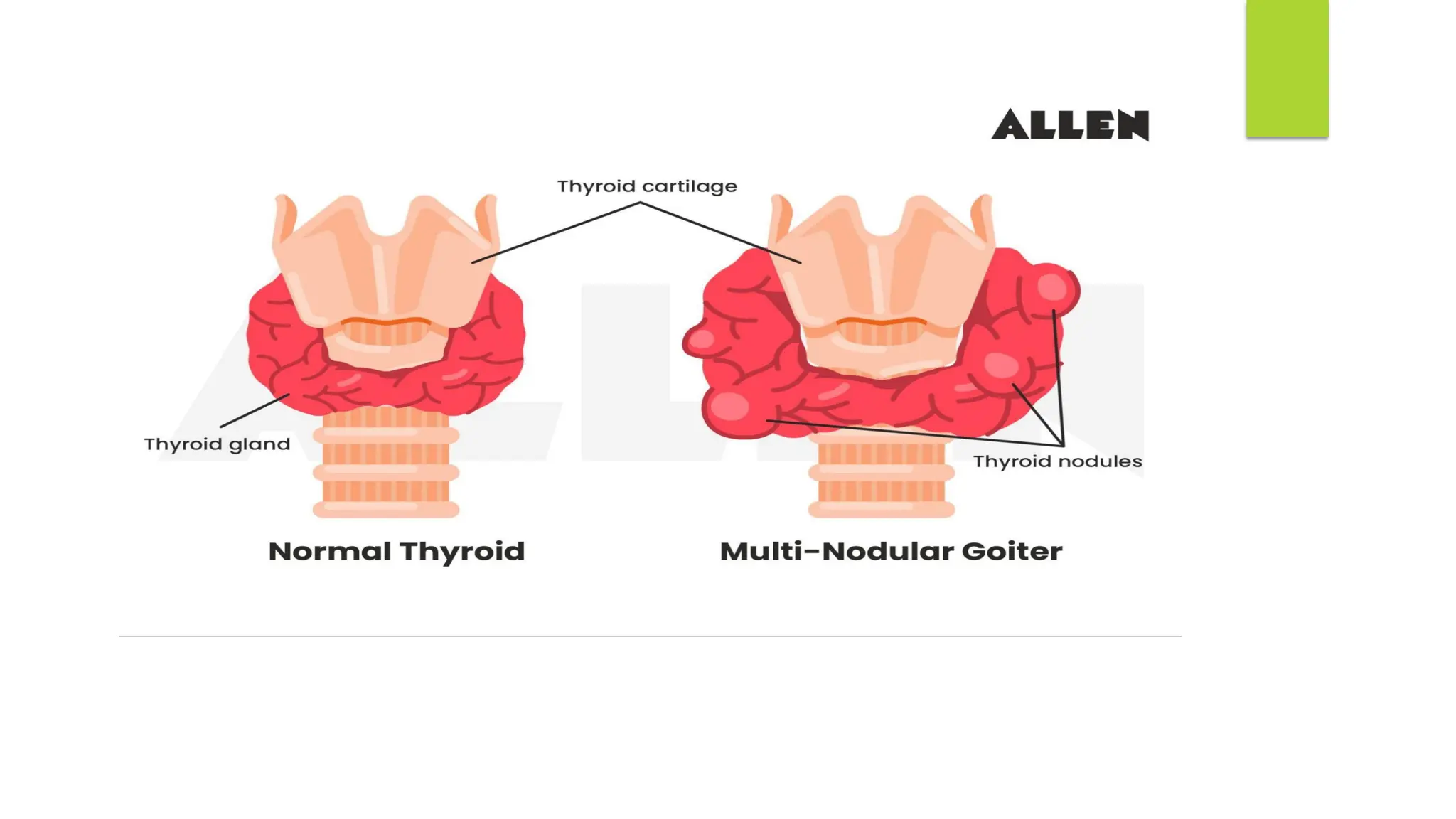 CASE PRESENTATION ON MULTINODULAR GOITRE BY DR JESMINA KHATUN | PDF