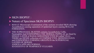 Case presentation on pemphigus vulgaris | PPTX