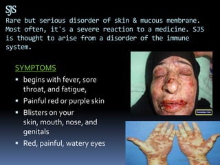 Case presentation on sjs | PPTX