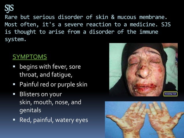 Case presentation on sjs | PPTX | Blood Disorders | Diseases and Conditions