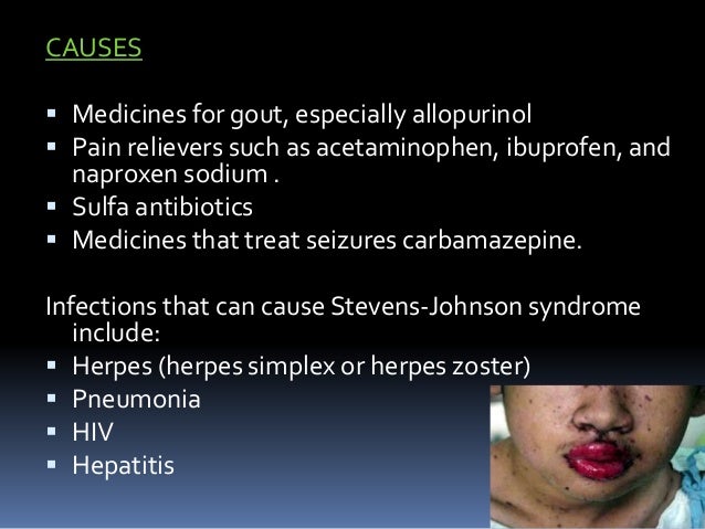 Case presentation on sjs