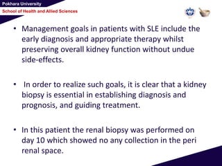 Case presentation on sle | PPTX