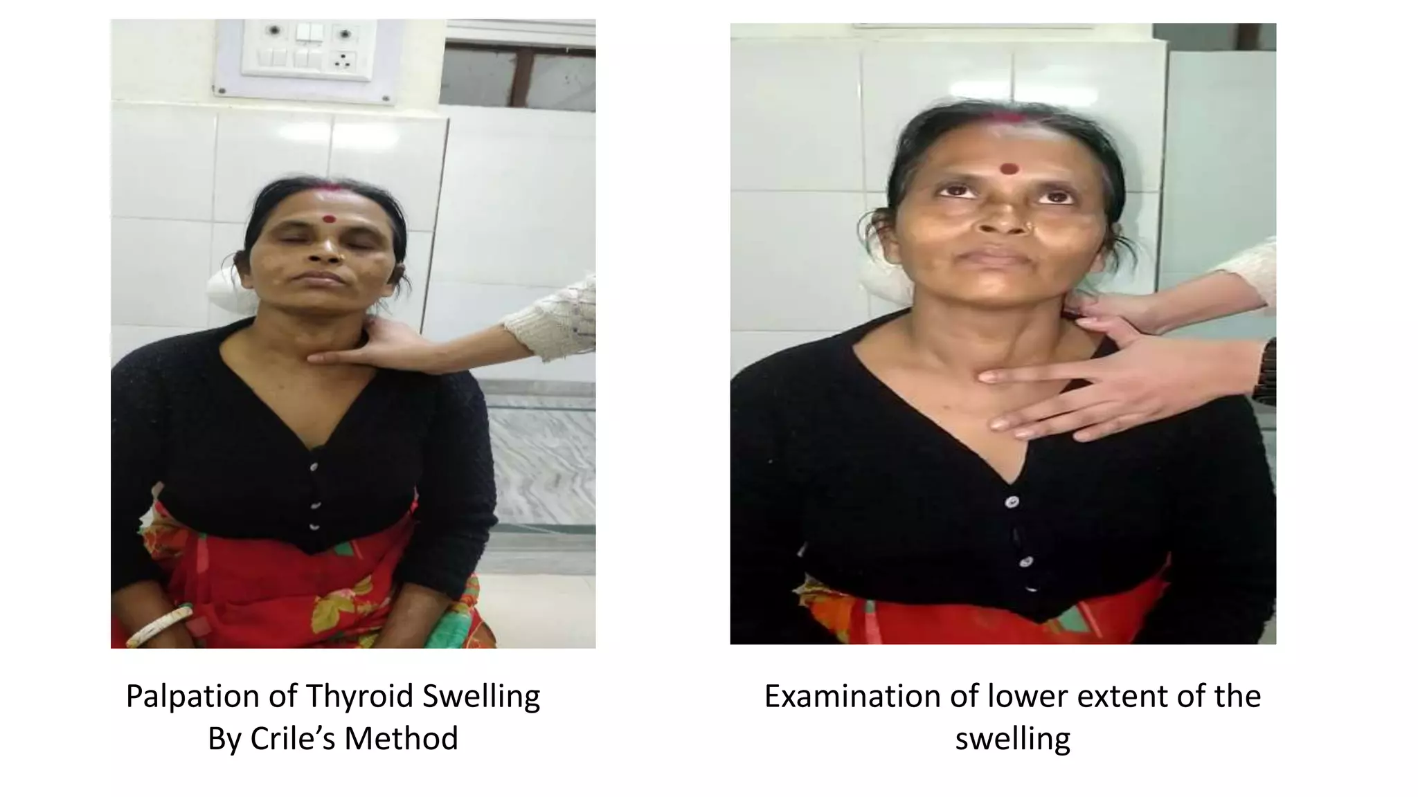 Case Presentation on Thyroid Swelling-2.pptx