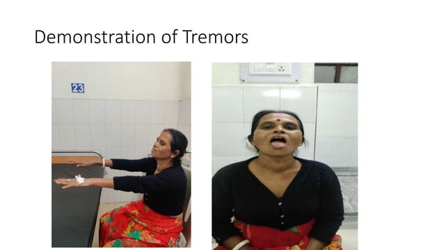 Case Presentation On Thyroid Swelling 2 Pptx Thyroid Disorders