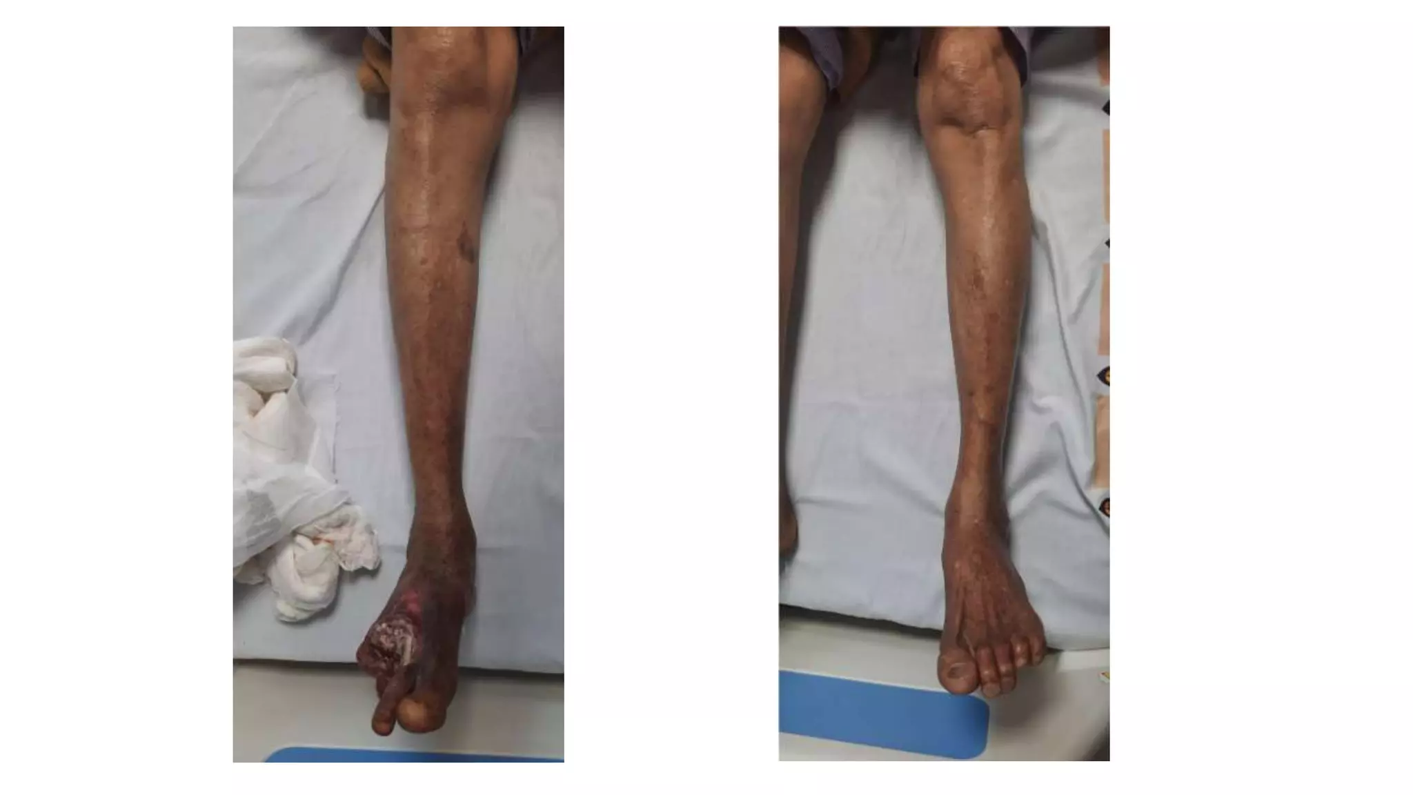 Case Presentation PVD+Diabetic Foot.pptx | Foot Health | Diseases and ...