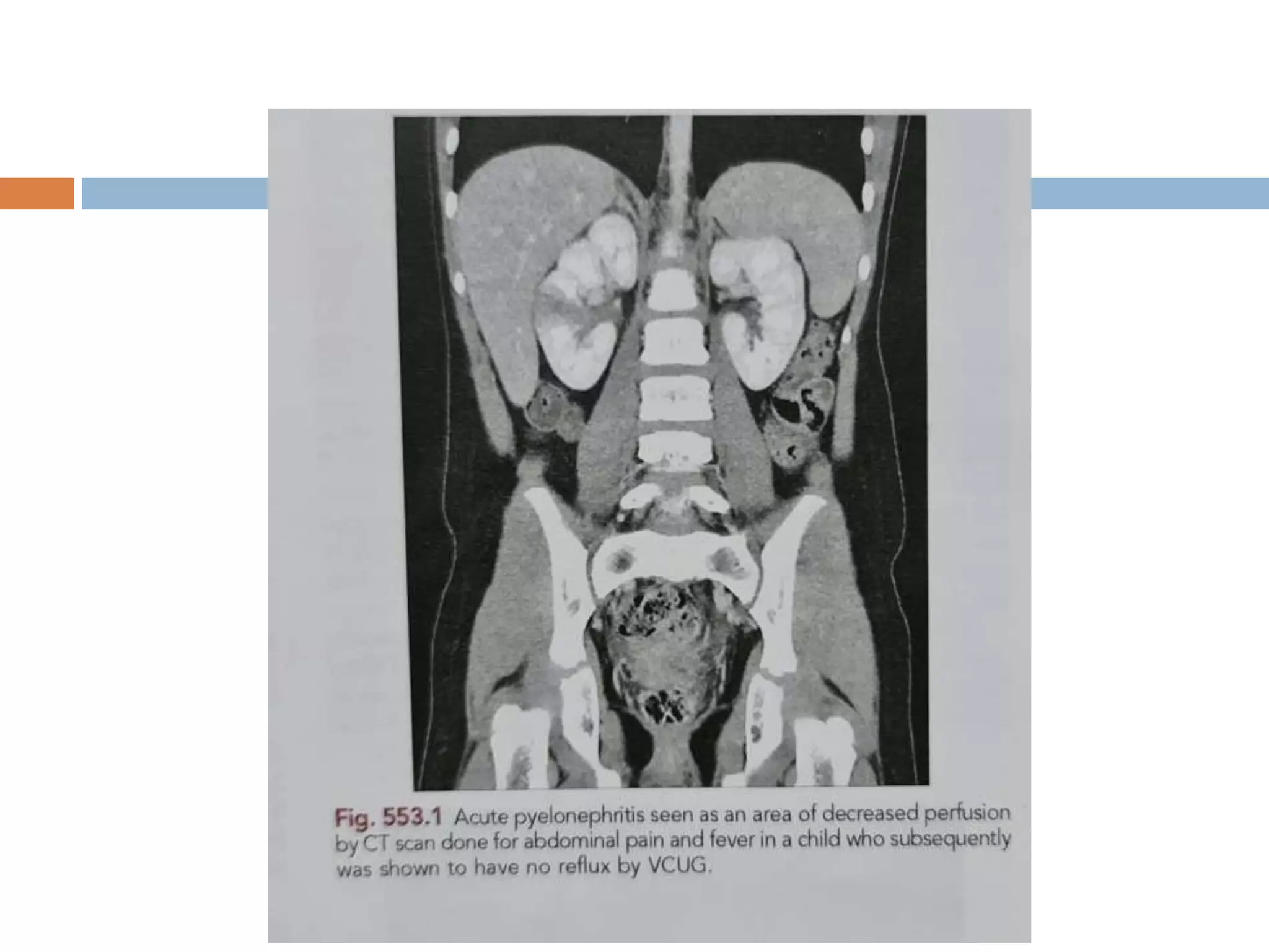 Case presentation of pyelonephritis.pptx