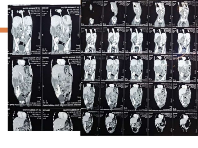 Case presentation of pyelonephritis.pptx