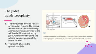 Case Presentation of Quadriceplasty.pptx | Death, Injury, or Military ...