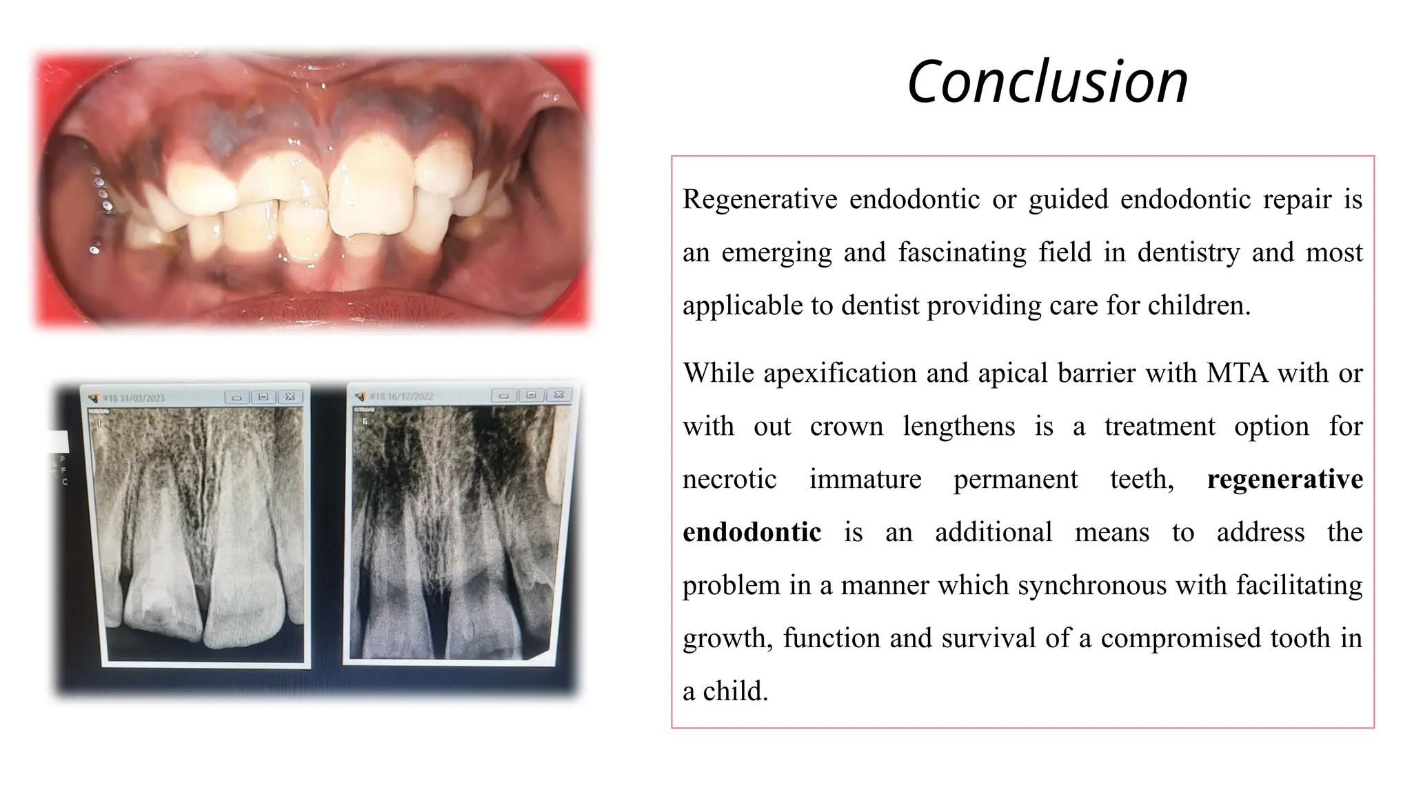 Case Presentation Regenerative endodontics.pptx