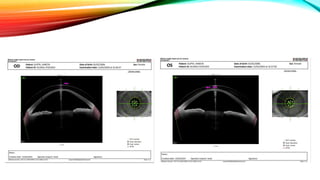 Scleral contact lens Case presentations kunj | PPTX
