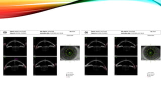 Scleral contact lens Case presentations kunj | PPTX