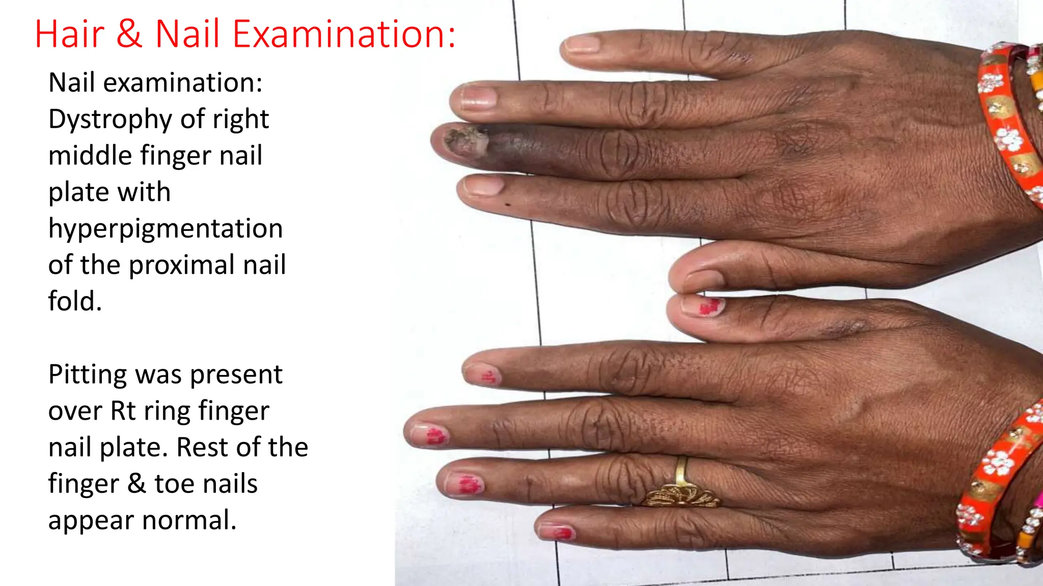 Case Presentation Systemic lupus erythematosus ).pptx