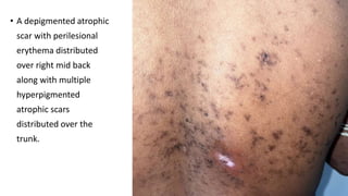 Case Presentation Systemic lupus erythematosus ).pptx