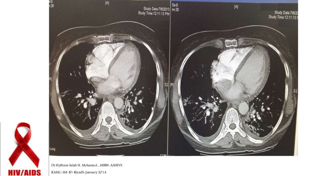 The First Case Report : Mycobacterium riyadhense Pneumonia Newly Dia…
