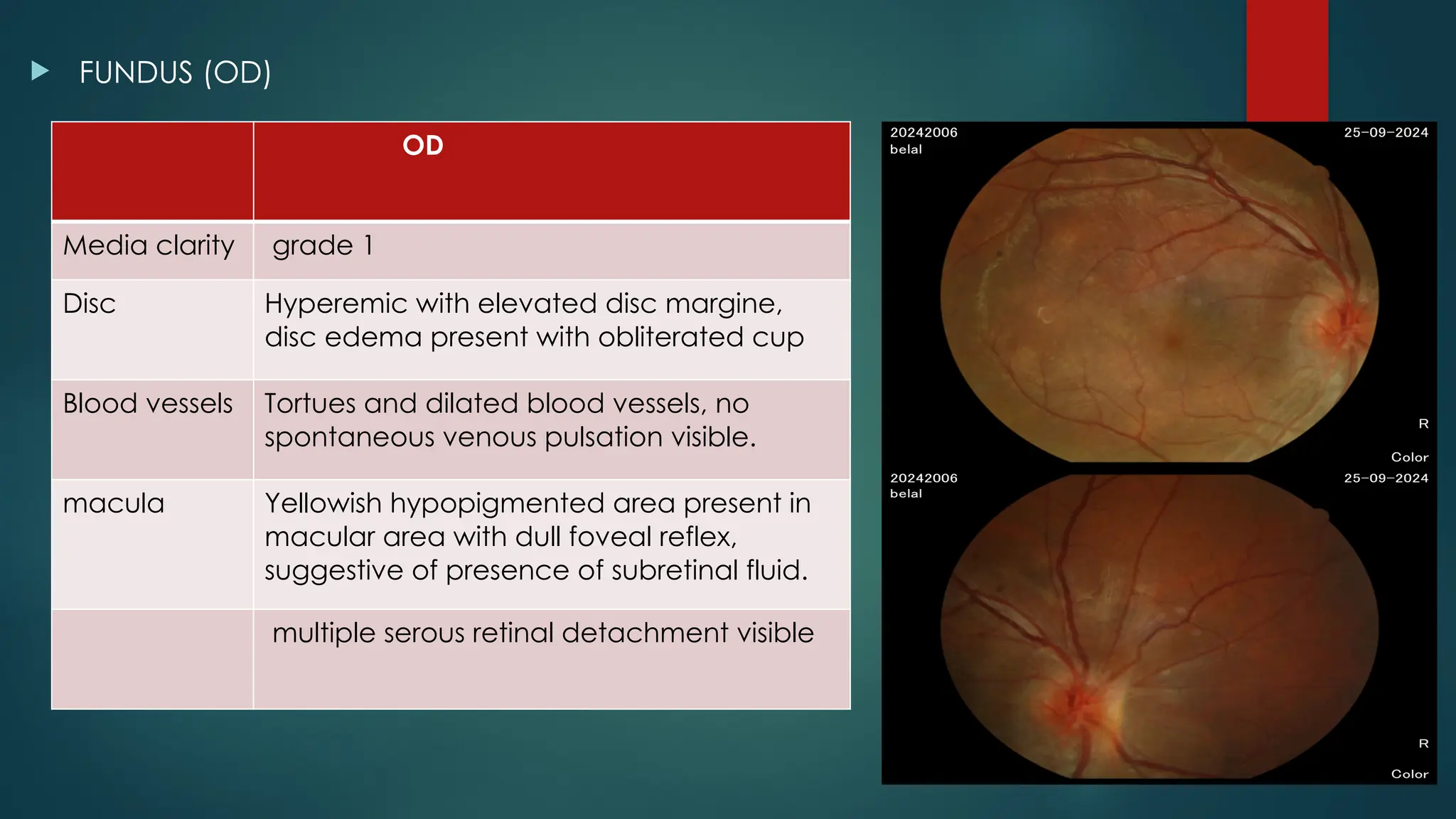 CASE PRESENTATION Vernal keratocunjunctivitis | PPTX