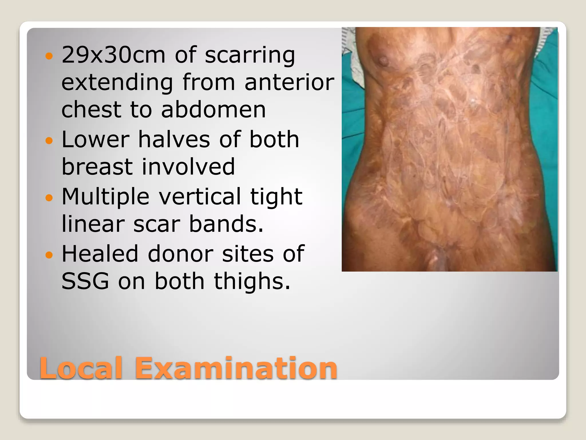 Case presented of flame burned abdomen | PPTX