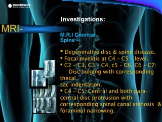 Thecal Sac Indentation