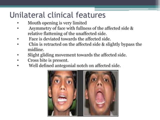 Case prsentation tmj ankylosis | PPTX