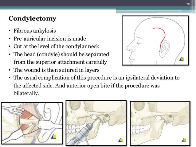 Case prsentation tmj ankylosis เสร็จ