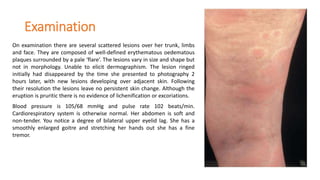 Case quiz by chronic urticaria disease.pptx