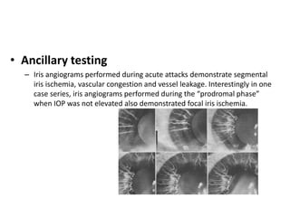 case report.This is a 60 years old female patient, a known Glaucoma ...