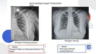 laporan kasus fraktur 1/3 distal clavicula | PPTX