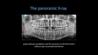 Severe anterior open bite in a Class II hyperdivergent adult patient: A ...