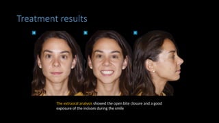 Severe anterior open bite in a Class II hyperdivergent adult patient: A ...