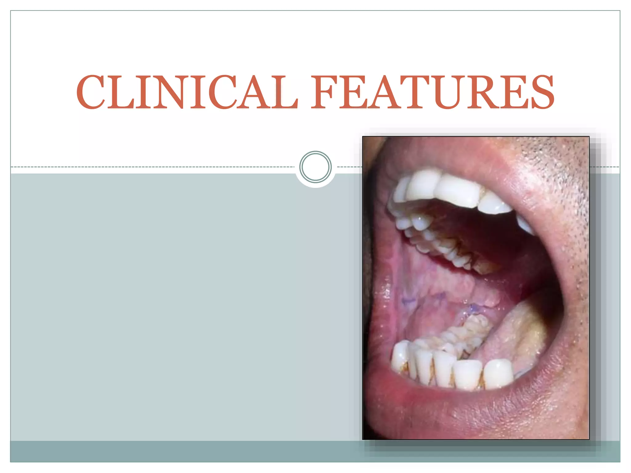 Case report-bilateral parotid swelling with oral submucous fibrosis | PPTX