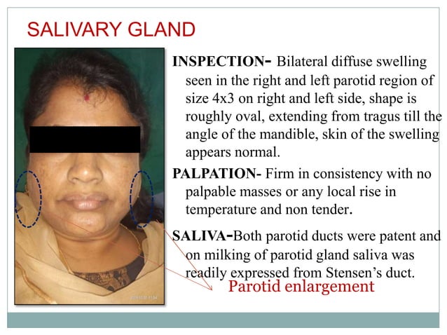 Case report-bilateral parotid swelling with oral submucous fibrosis | PPT