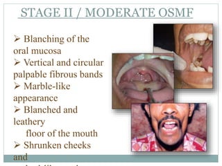 Case report-bilateral parotid swelling with oral submucous fibrosis | PPTX