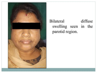 Case report-bilateral parotid swelling with oral submucous fibrosis | PPTX