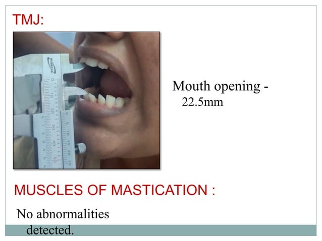 Case report-bilateral parotid swelling with oral submucous fibrosis | PPT