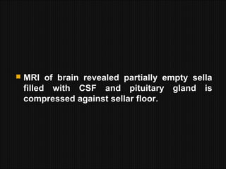 Case report: Empty sella syndrome | PPT