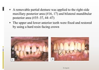 Case report Chronic Generalized periodontitis with Type 2 DM | PPTX