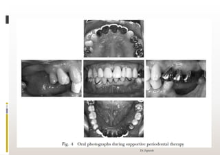 Case report Chronic Generalized periodontitis with Type 2 DM | PPTX