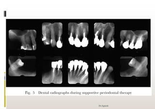 Case report Chronic Generalized periodontitis with Type 2 DM | PPTX