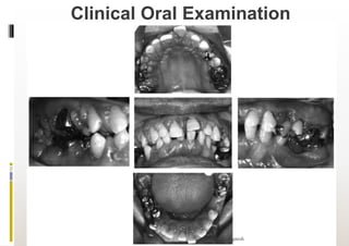 Case report Chronic Generalized periodontitis with Type 2 DM | PPTX