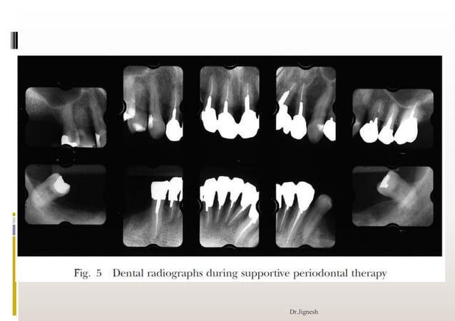Case report Chronic Generalized periodontitis with Type 2 DM