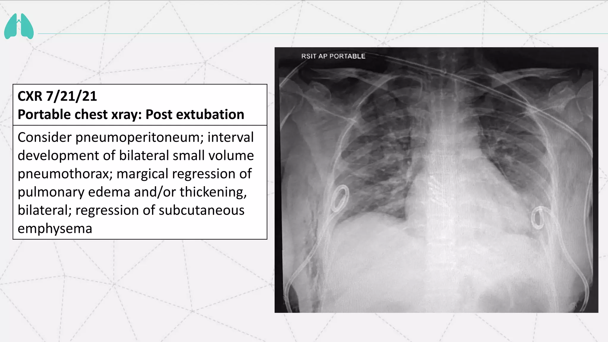CASE REPORT- Pneumothorax.pptx