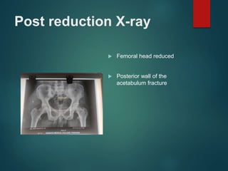 CASE REPORT ACETABULAR FRACTURE GOA.pptx