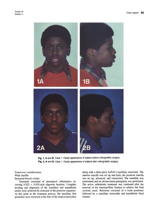 Case Report: Advancement genioplasty | PDF