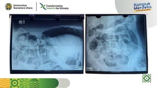 Case Report Anatomi Gaster dan Perforasi Gaster.pptx