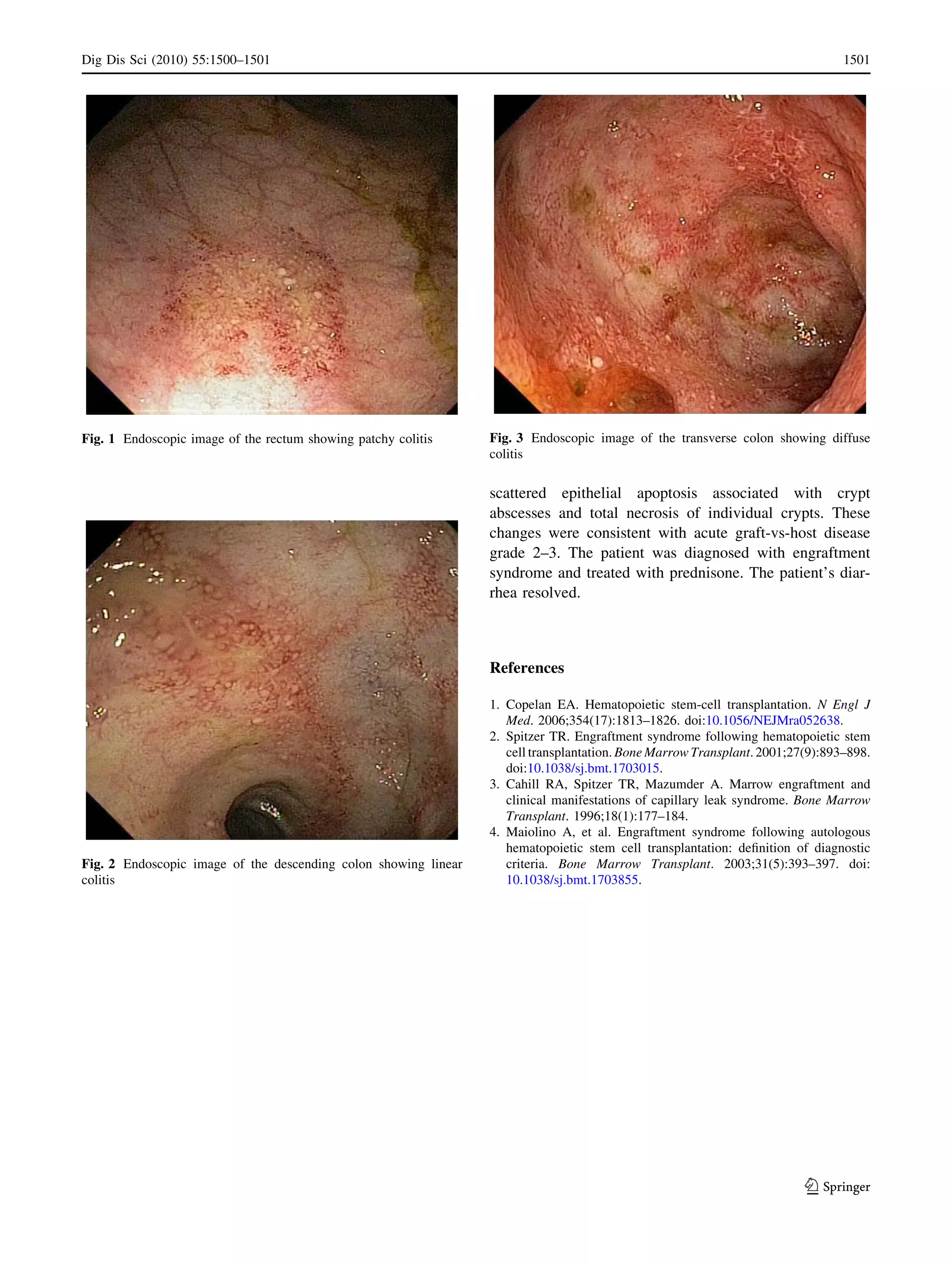 Colitis secondary to engraftment syndrome post ABMT | PDF