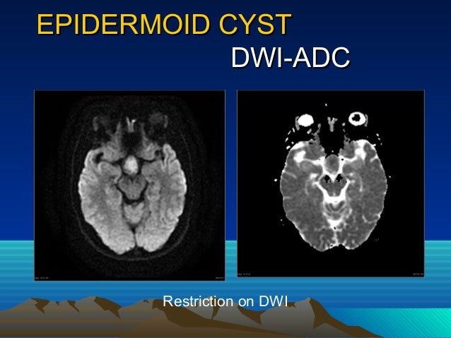 Case report: atypical Rathkes cleft cyst