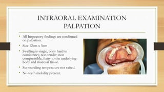 CASE REPORT on fiborous dysplasia in maxillary regionpptx | PPTX