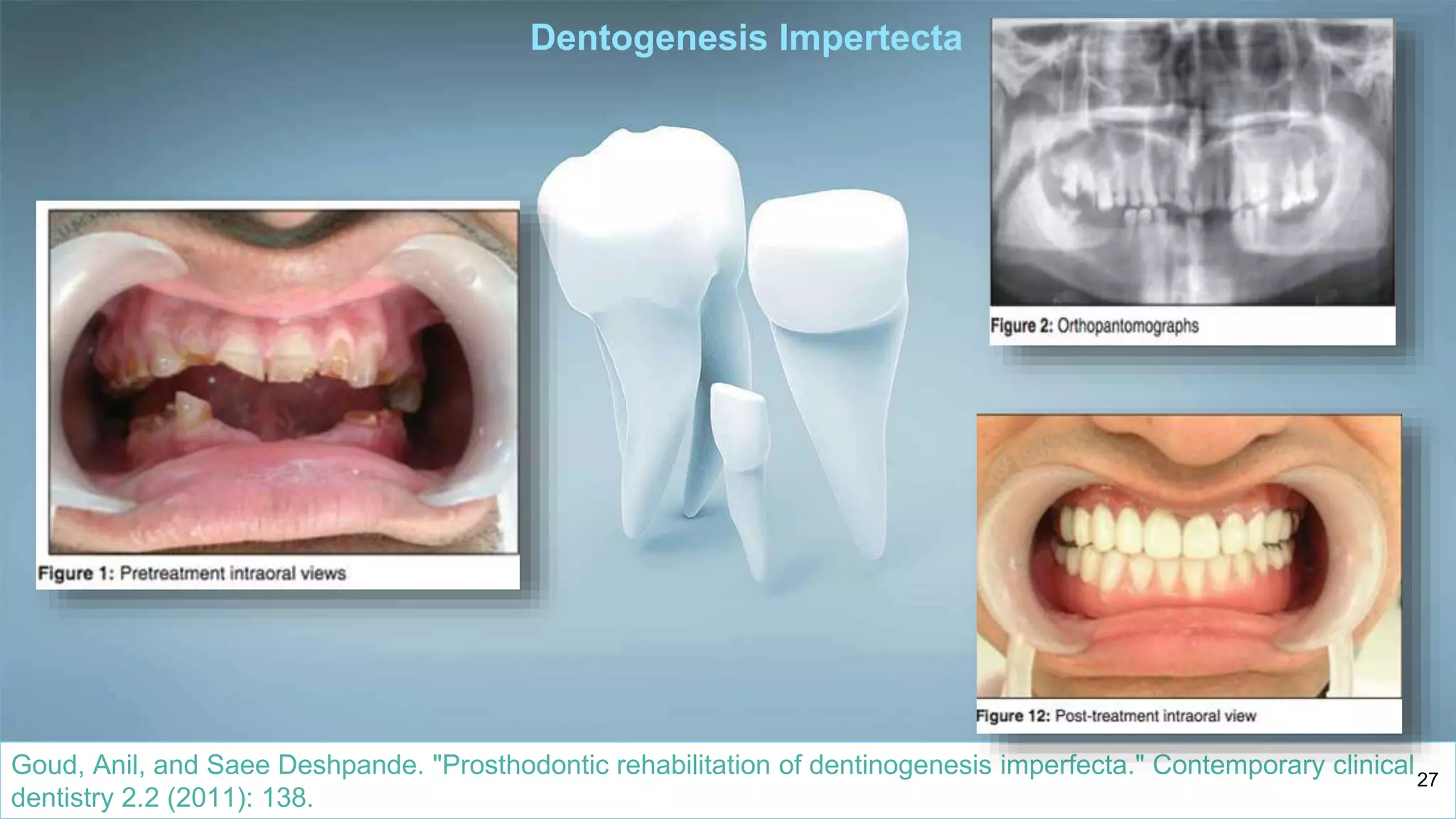 full mouth rehabilitation | PPTX