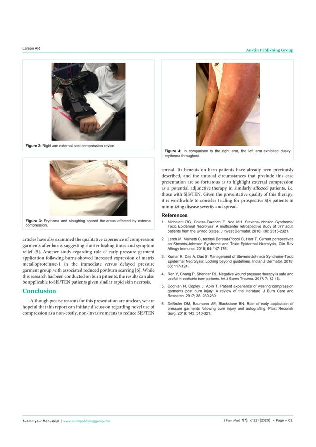 Austin Publishing Group- Case report of external compression in stevens ...