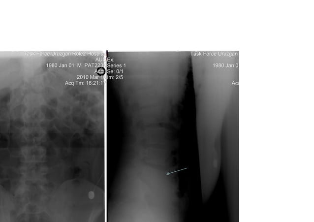 Case report of thoracic spine fractures from ied blast in armoured ...
