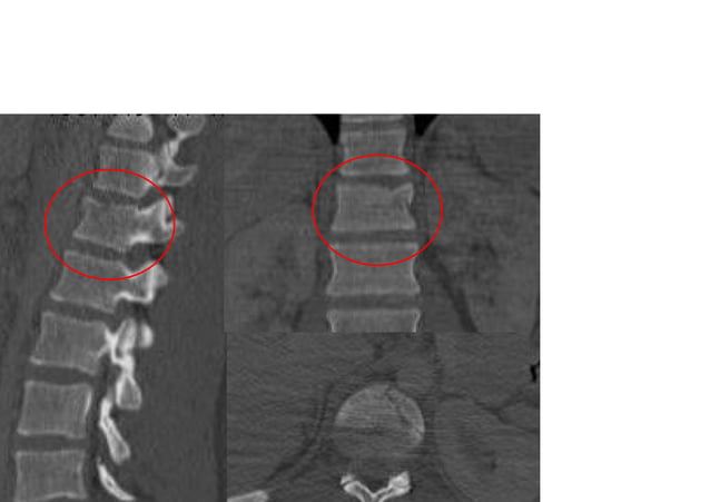 Case report of thoracic spine fractures from ied blast in armoured ...